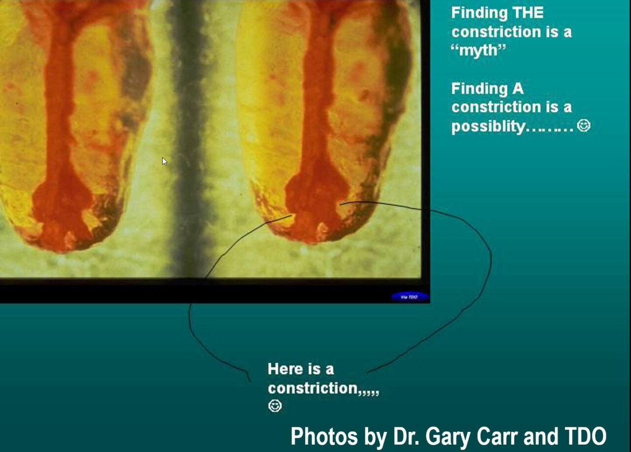 The End Is Near (To What Level Do We Fill Canals?) - EndoExperience