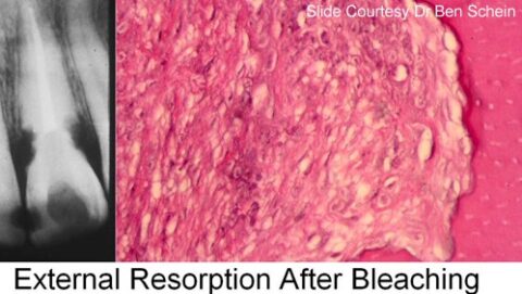 Canal Protection for Non-Vital Bleach - EndoExperience