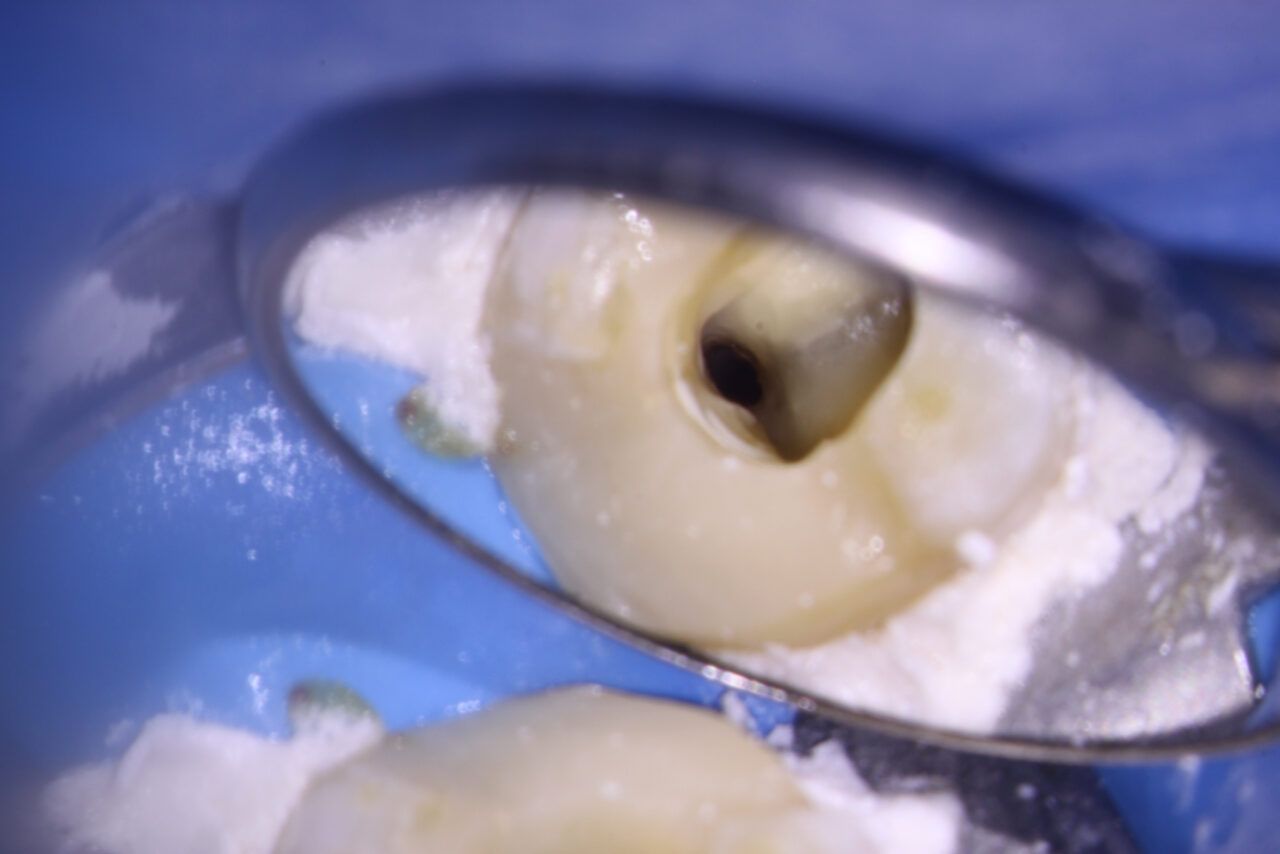 May 2020 - Multiple Foramina - EndoExperience