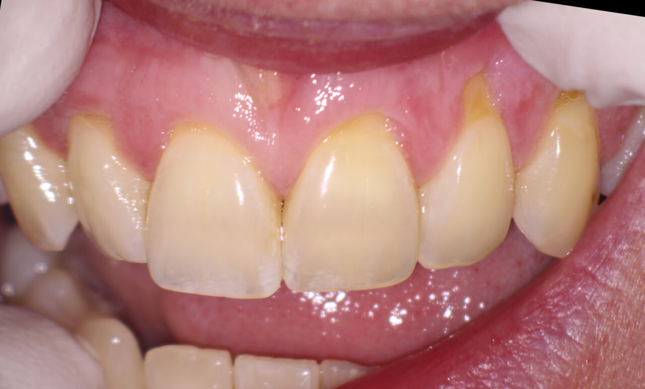 February 2019 - Root Exposure and Thermal Sensitivity: Is Endo the ...
