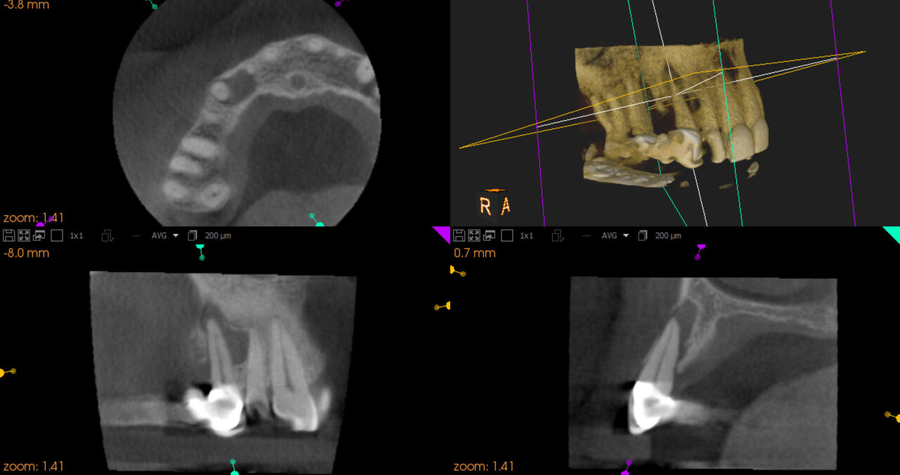 September 2020 - Lateral Radiolucency - EndoExperience
