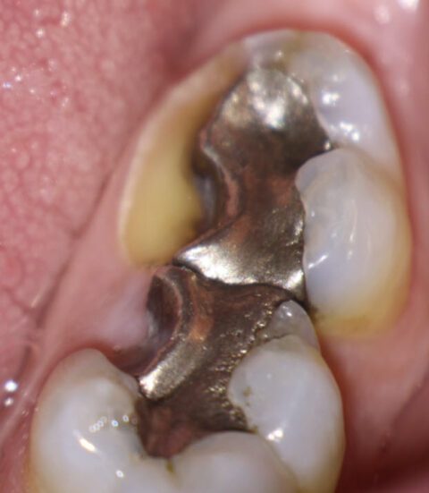 Cracked Tooth - EndoExperience