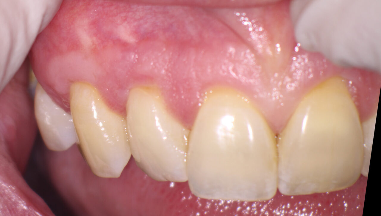 February 2019 - Root Exposure and Thermal Sensitivity: Is Endo the ...