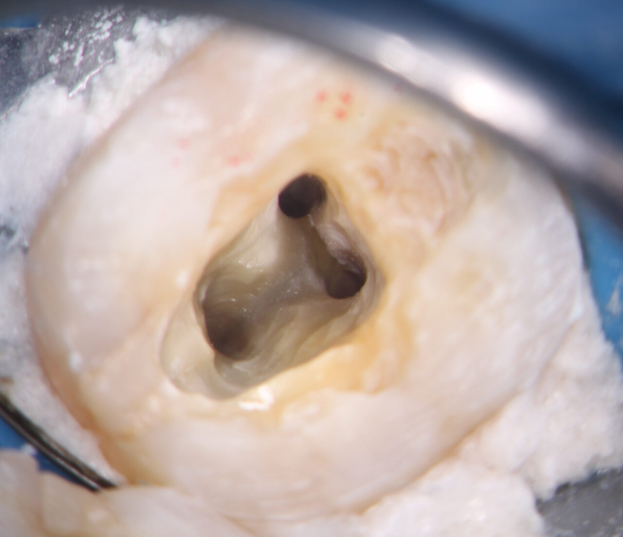 August 2020 - Salvaging a Cracked Molar - EndoExperience