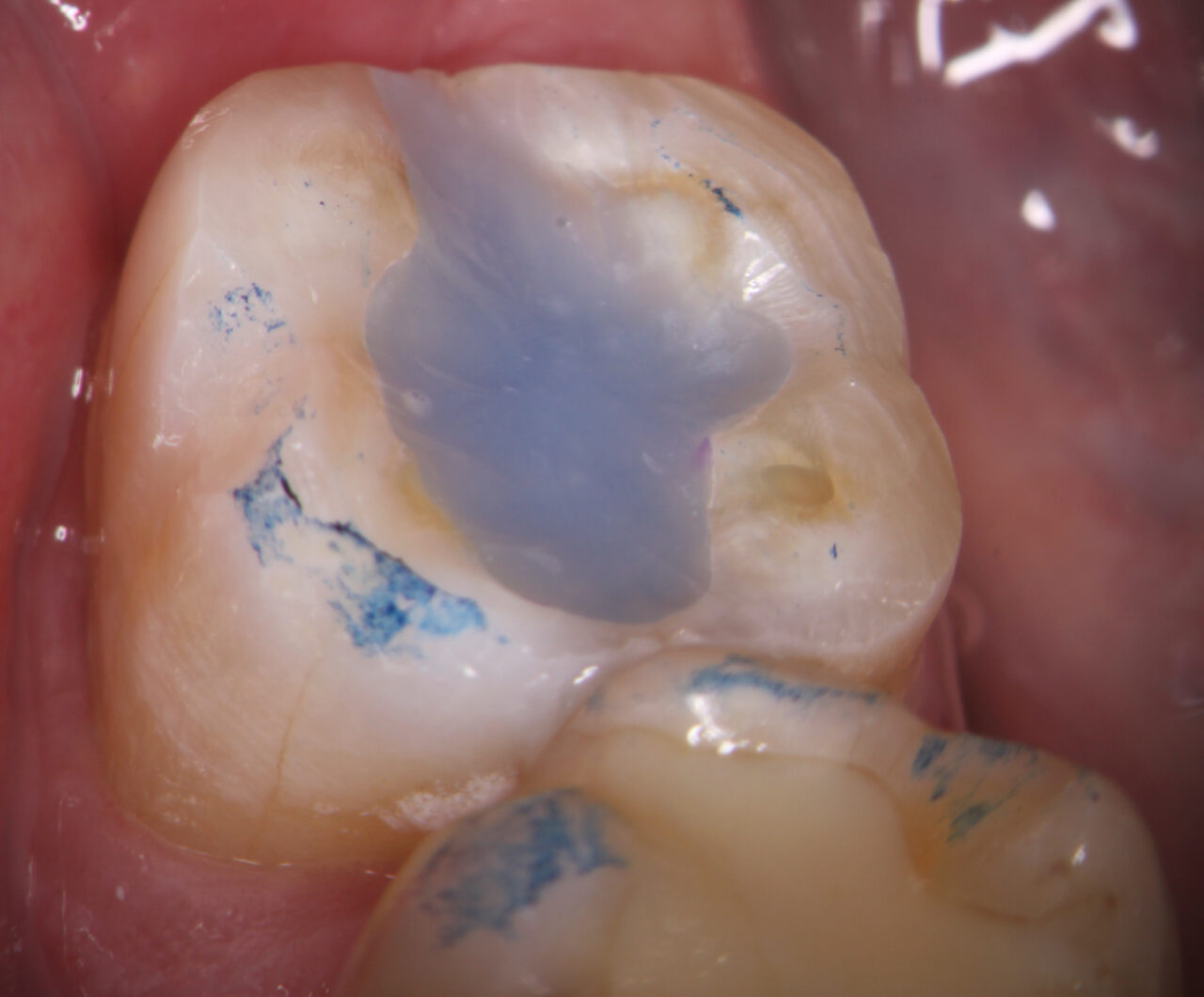 August 2020 - Salvaging a Cracked Molar - EndoExperience