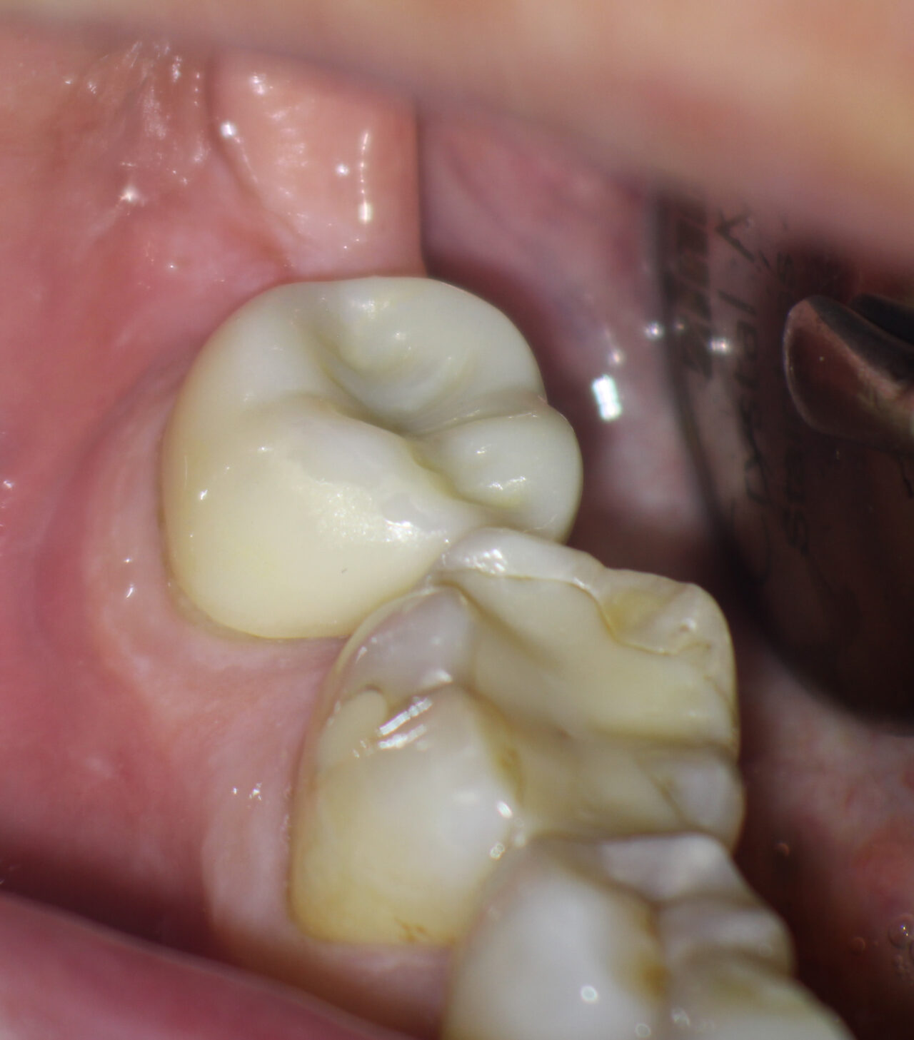 August 2020 - Salvaging a Cracked Molar - EndoExperience