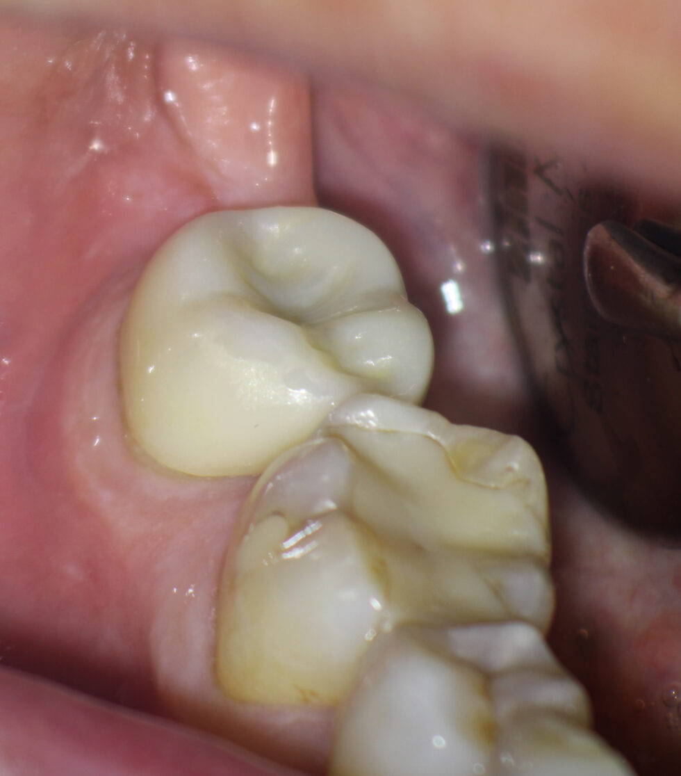August 2020 - Salvaging a Cracked Molar - EndoExperience