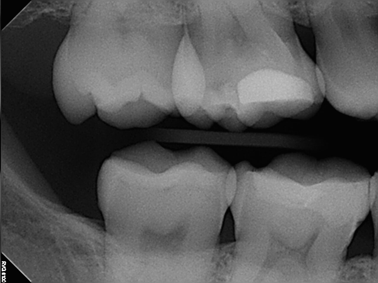 August 2020 - Salvaging a Cracked Molar - EndoExperience