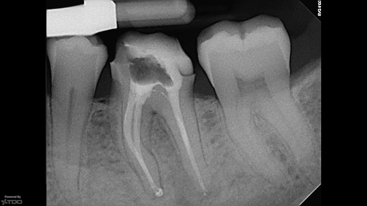 October 2019 - Furcal Lesion Heals Nicely - EndoExperience