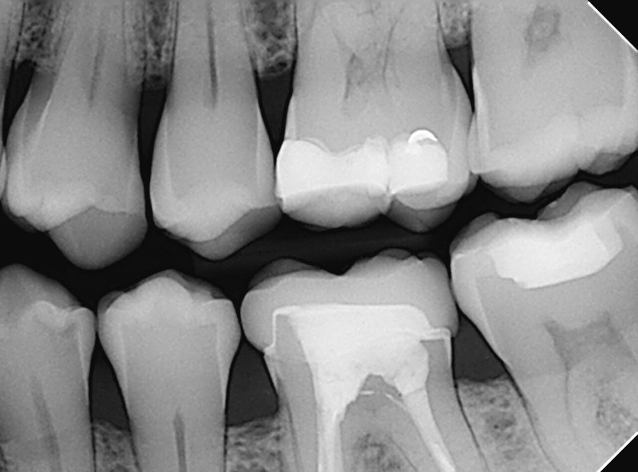 October 2019 - Furcal Lesion Heals Nicely - EndoExperience