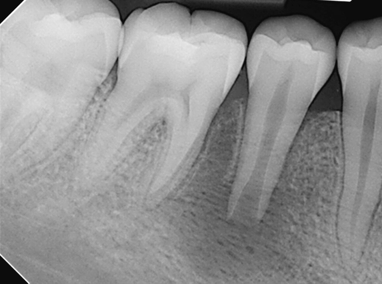 December 2018 - Management of Dens Evaginatus - EndoExperience