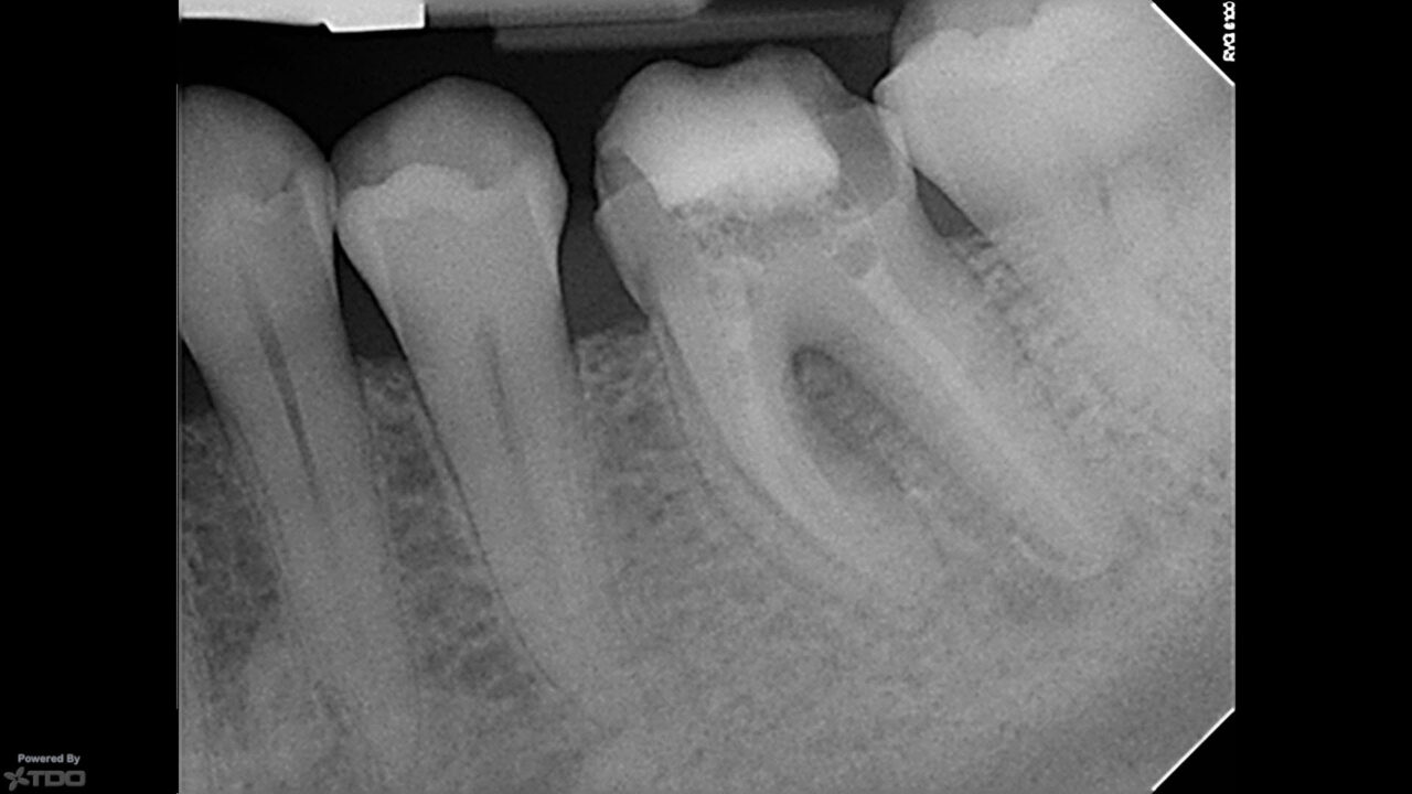 October 2019 - Furcal Lesion Heals Nicely - EndoExperience
