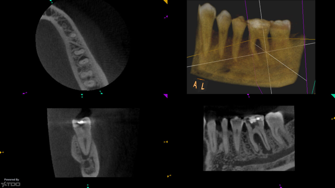 October 2019 - Furcal Lesion Heals Nicely - EndoExperience