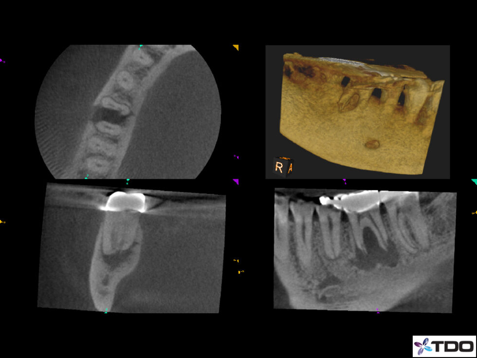 February 2020 - The Myth of the Apical Constriction - EndoExperience