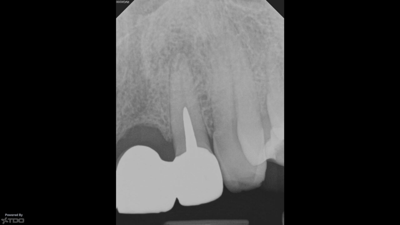 April 2021 - Retrograde canal filling of Unfilled Canal - EndoExperience