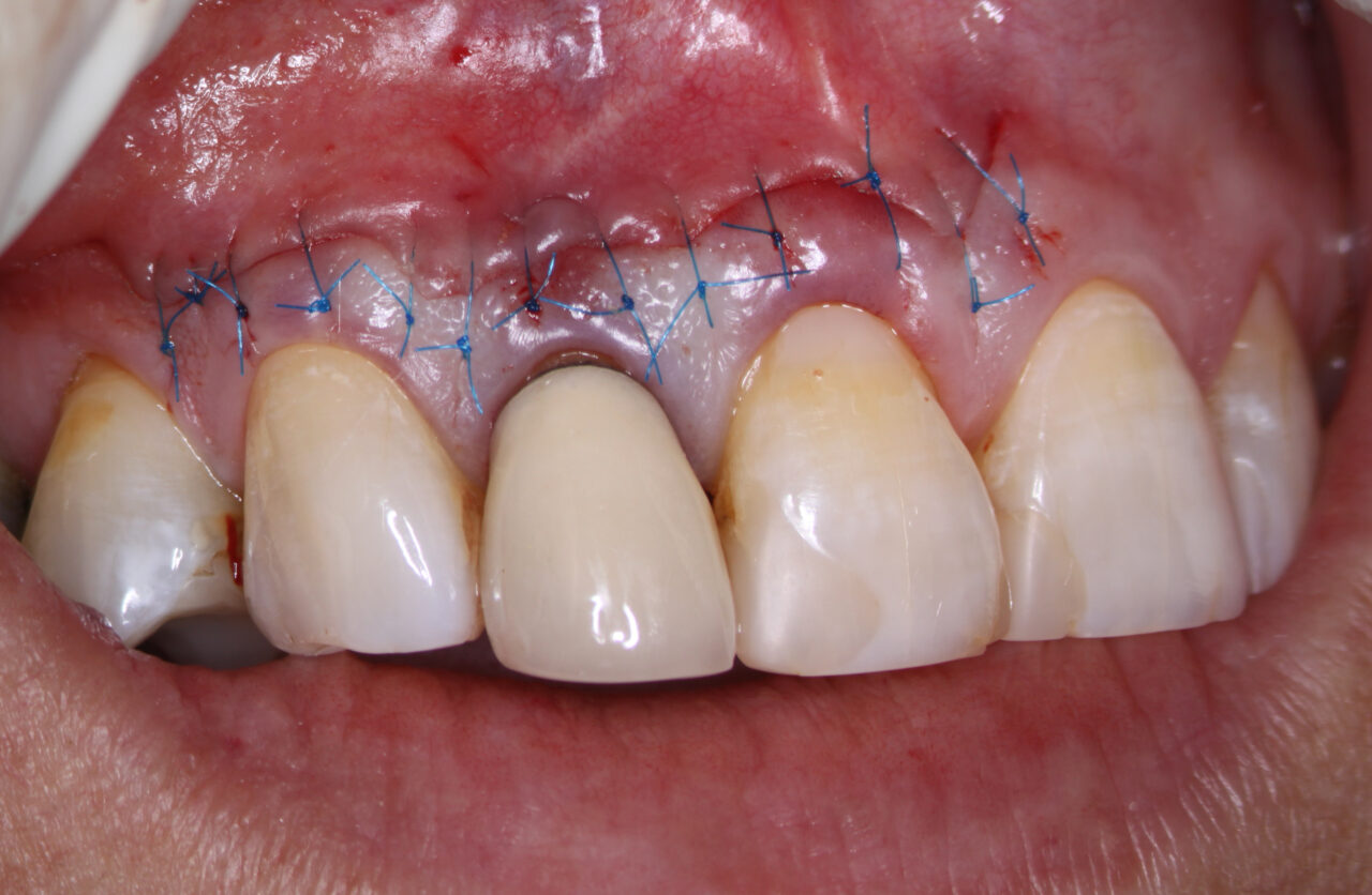 August 2021 - Surgical Endo Failure Due to Unusual Root Fracture ...