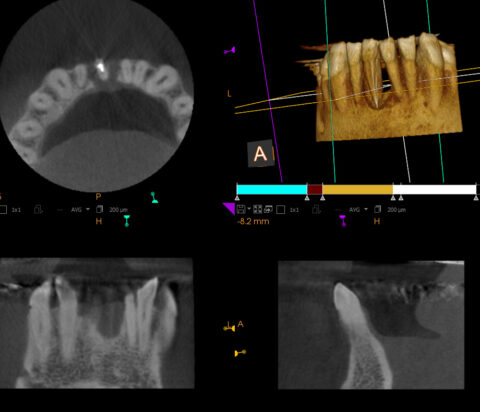 Sept. 2021 Cemental Tear - EndoExperience