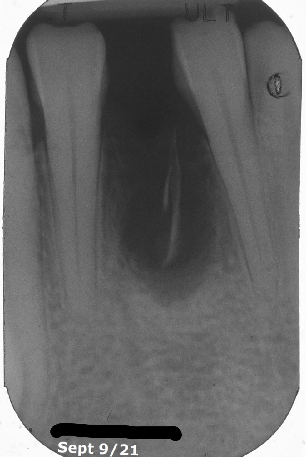 Sept. 2021 Cemental Tear - EndoExperience