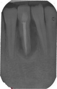 Sept. 2021 Cemental Tear - EndoExperience