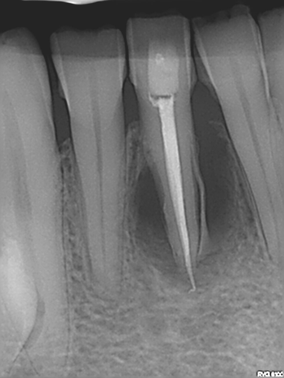 Sept. 2021 Cemental Tear - EndoExperience