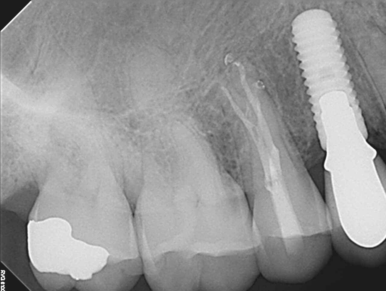 November 2021 3 Rooted Virgin Maxillary Premolar Requires Endo ...